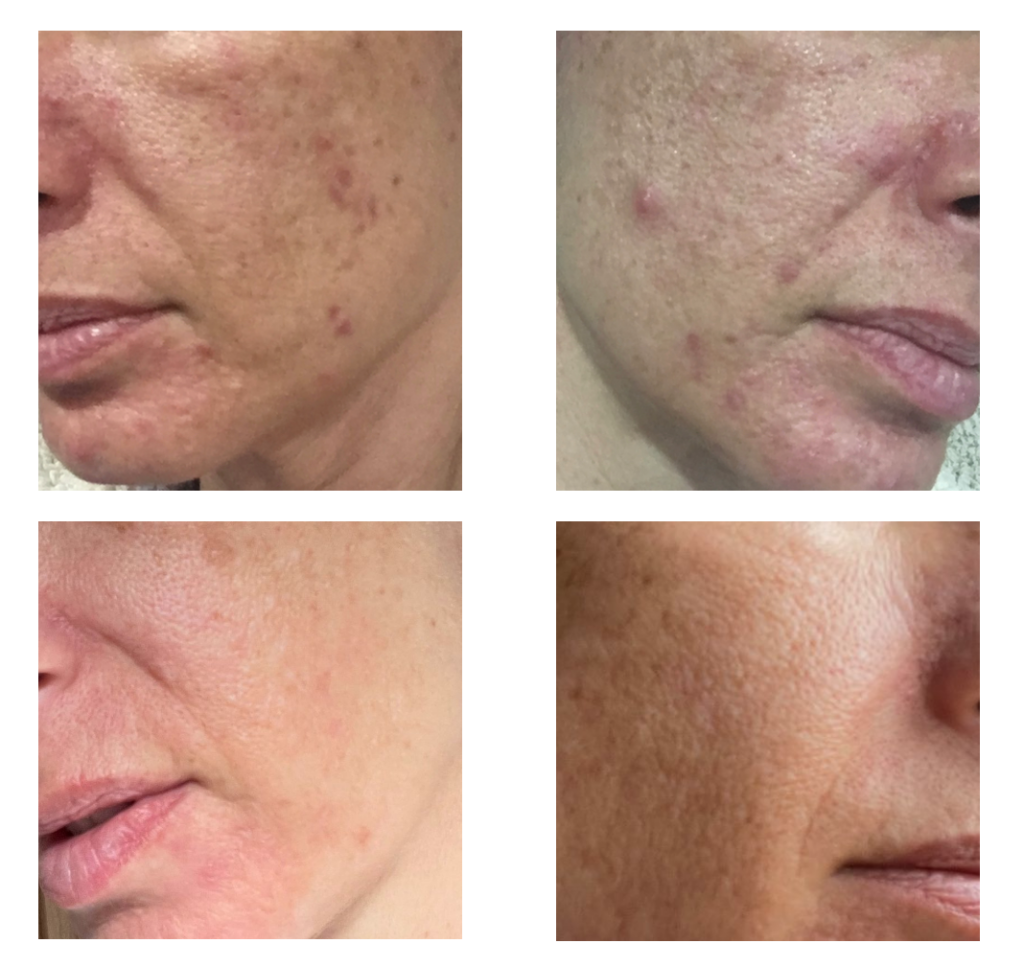 My skincare journey: Tackling cystic acne - Atopis